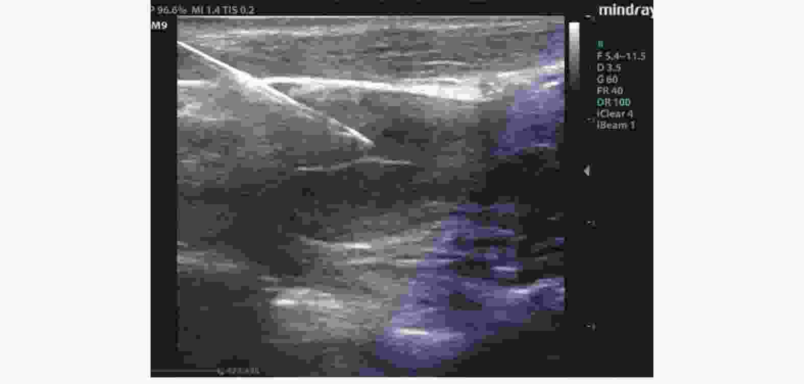 猕猴子宫腺肌病动物模型建立初探