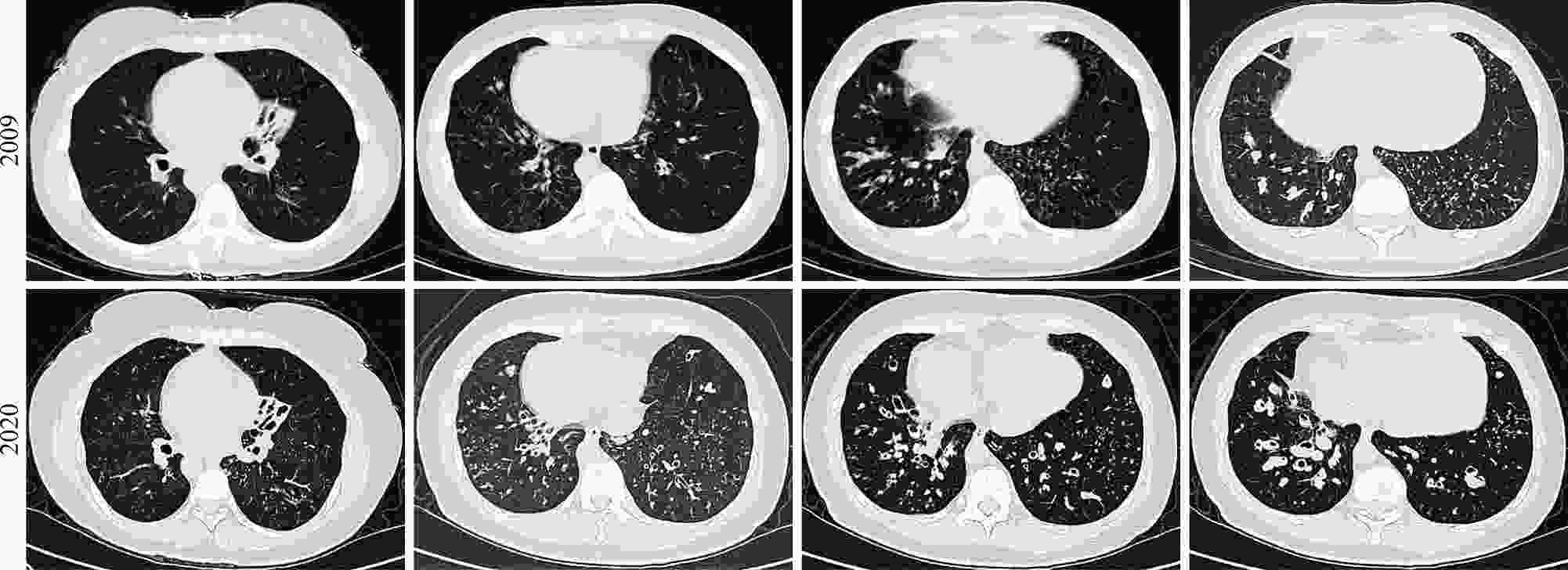 Kartagener综合征1例报告