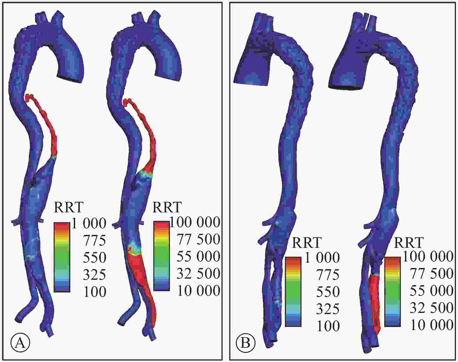 胸主动脉腔内修复术后血管重塑的血流动力学仿真分析