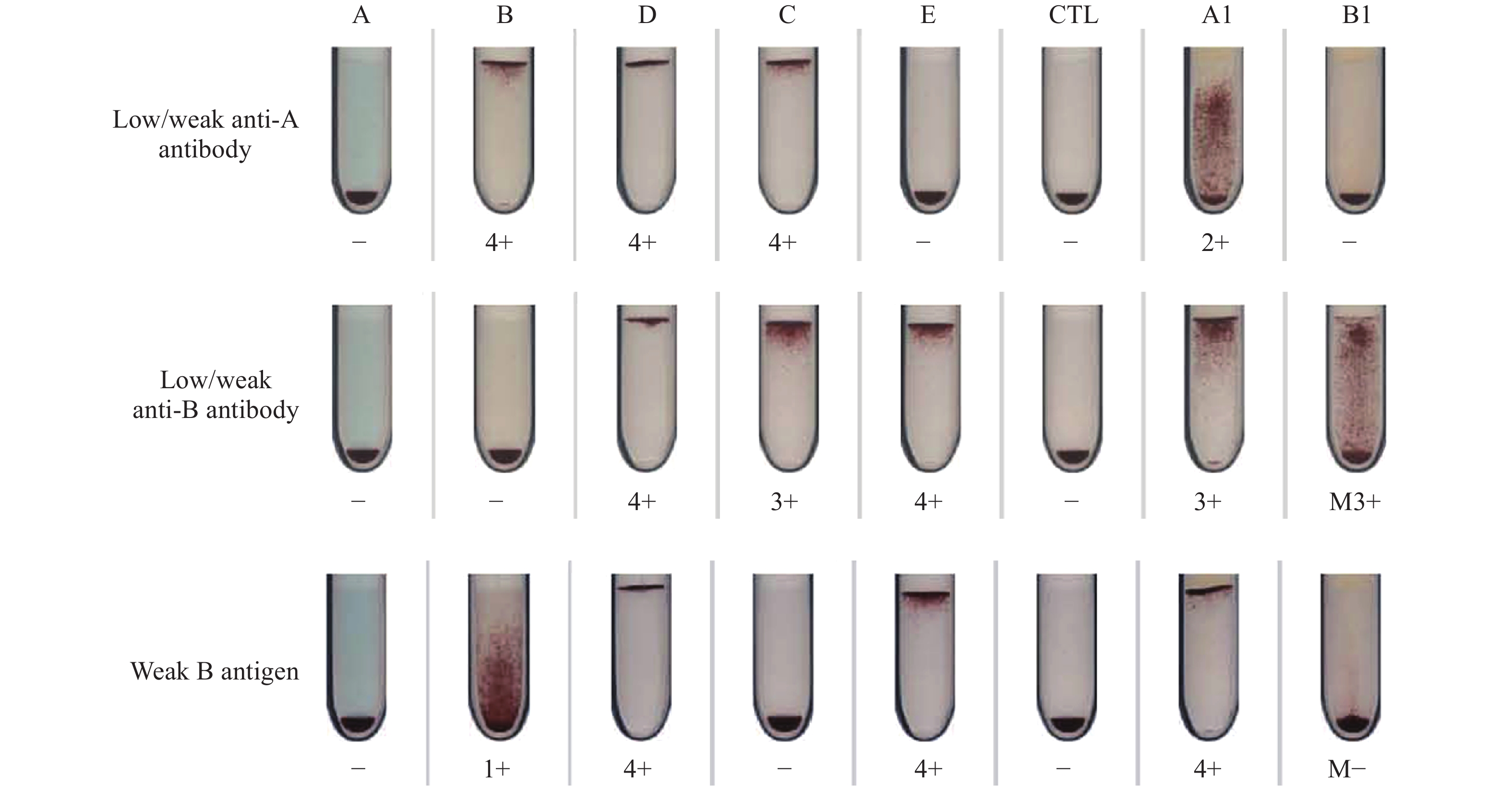 132例ABO血型正反定型不符患者的临床特点及相关影响因素分析