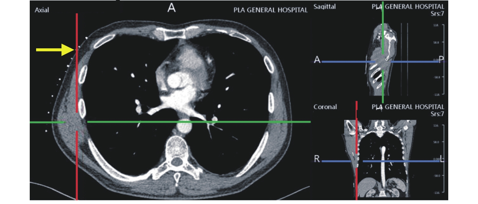 基于CT测量指标的张力性气胸急救穿刺针合适长度及穿刺入路的研究