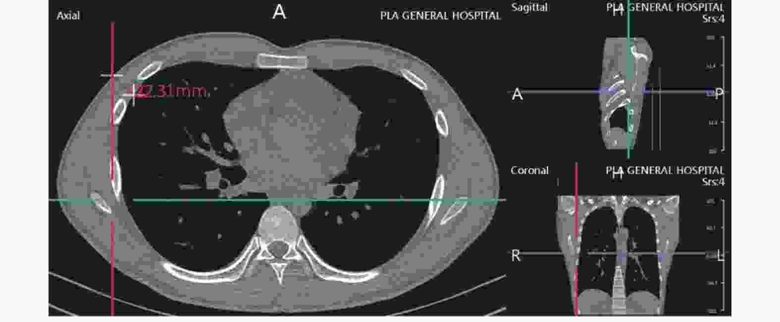 基于CT测量指标的张力性气胸急救穿刺针合适长度及穿刺入路的研究