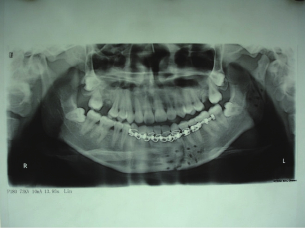 Retromandibular transparotid approach and absorbable bone fixation for ...