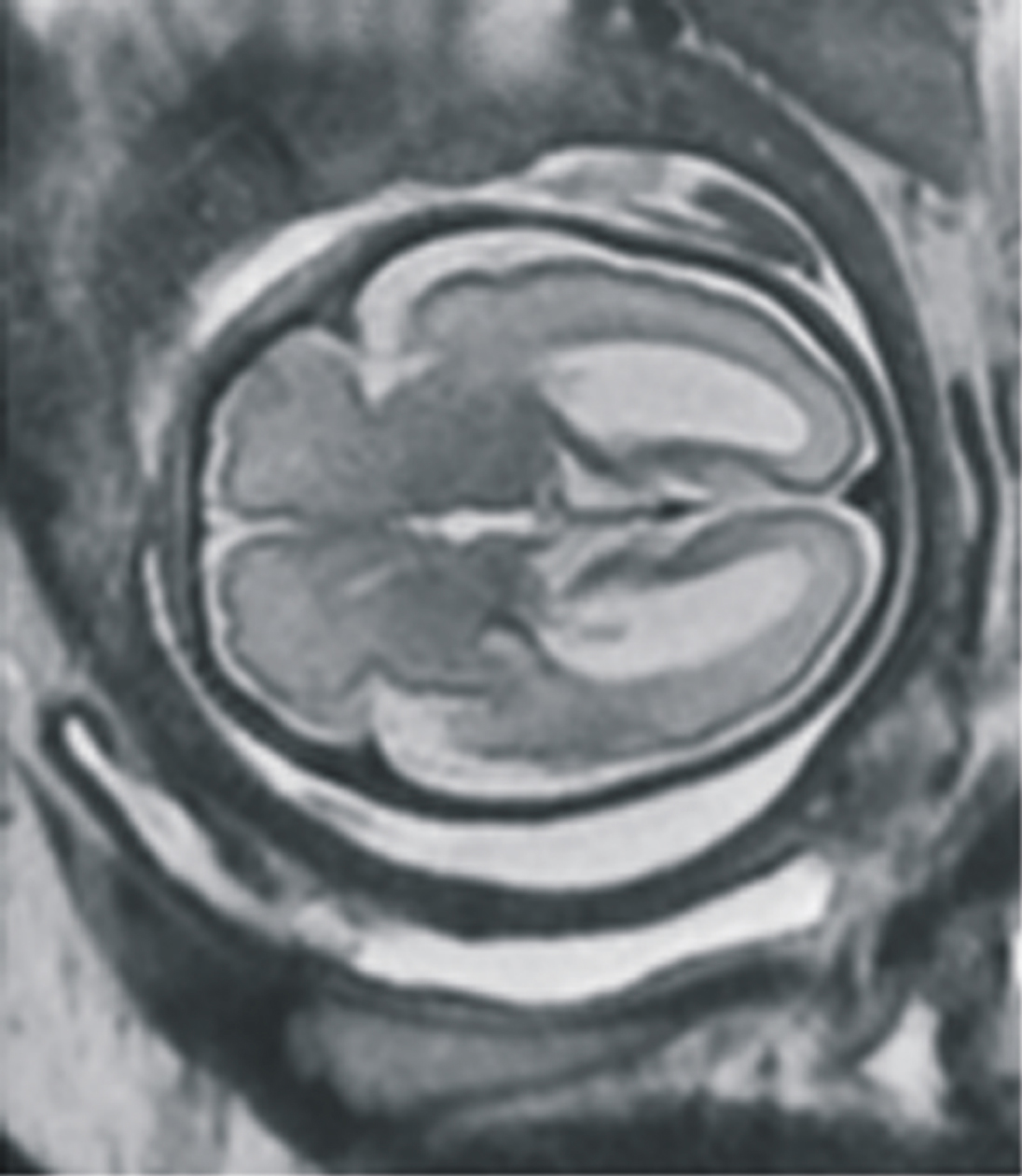 Clinical characteristics and prognosis of COL4A1/COL4A2 gene variants ...