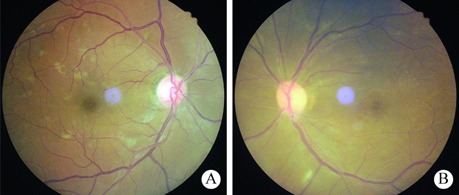 Fundus manifestations of different types of nephropathy in type 2 ...
