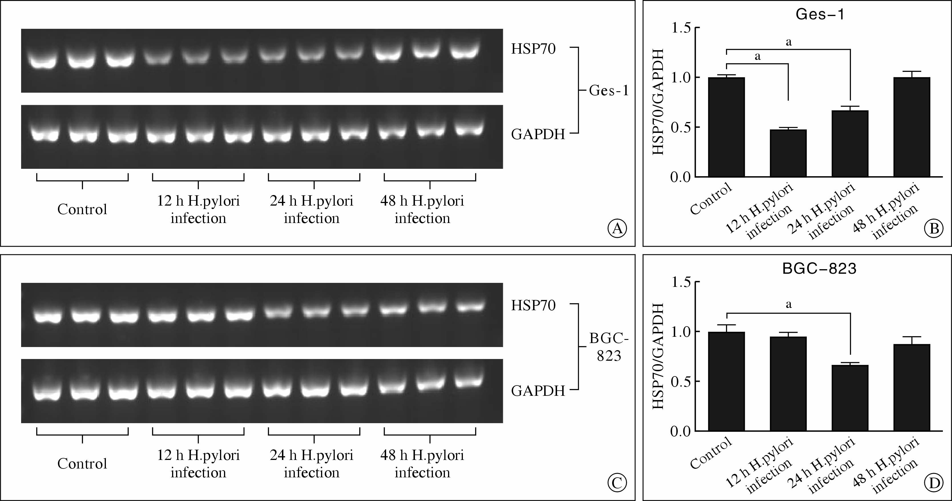 幽门螺杆菌感染对人胃黏膜和胃癌细胞热休克蛋白70表达的影响