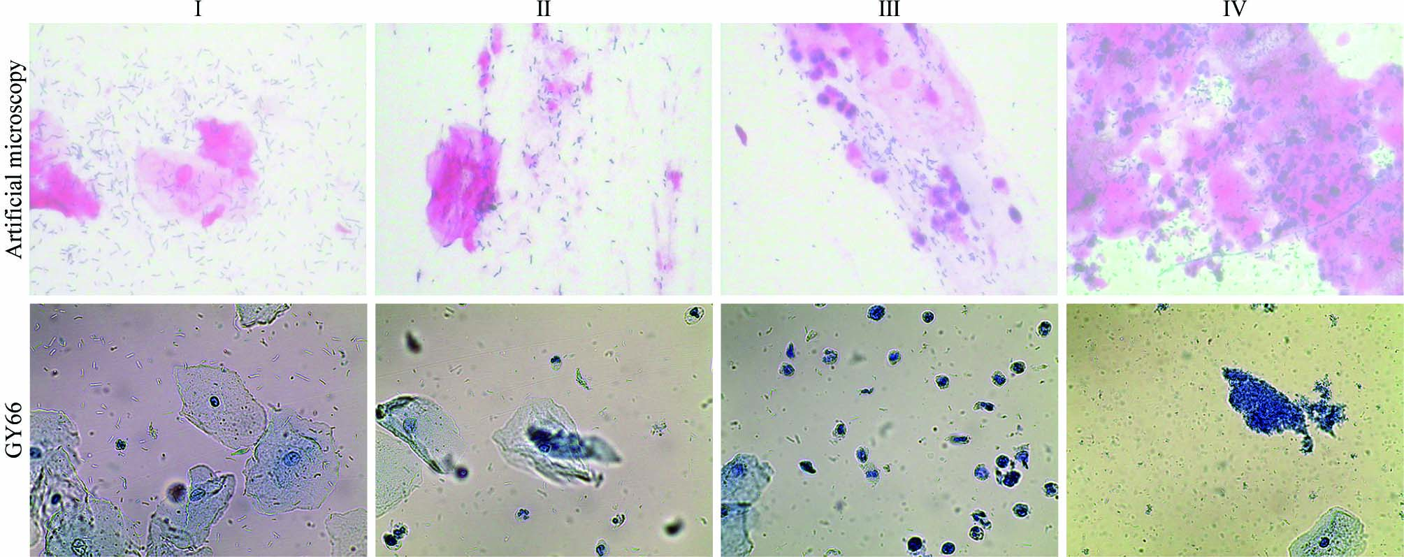 GY66阴道微生态形态学全自动检测仪临床应用评价