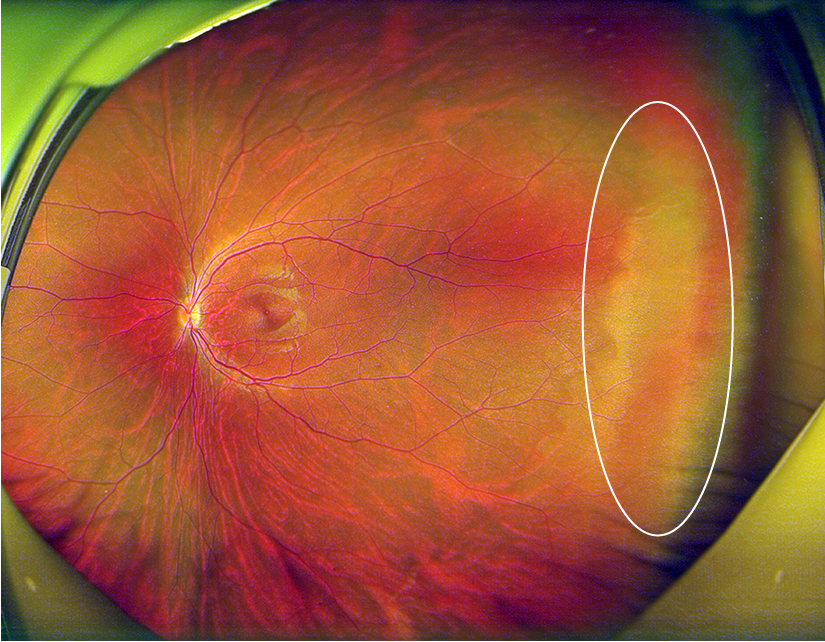 空军招飞中视力正常青少年周边视网膜异常体征检出率的横断面调查