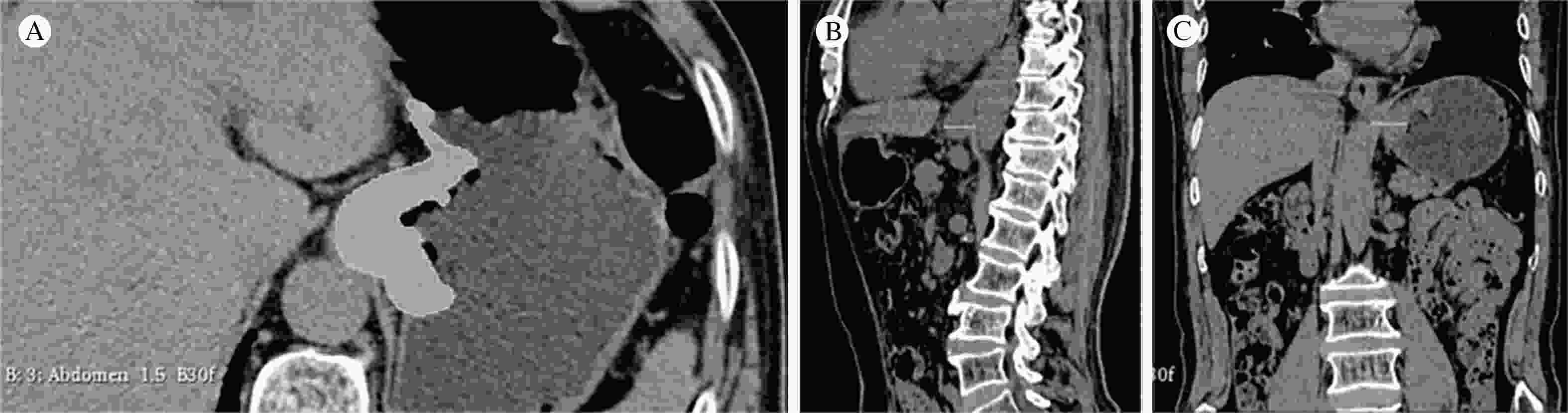 增强CT影像组学评分和临床指标列线图预测食管胃结合部腺癌患者脉管癌栓的价值