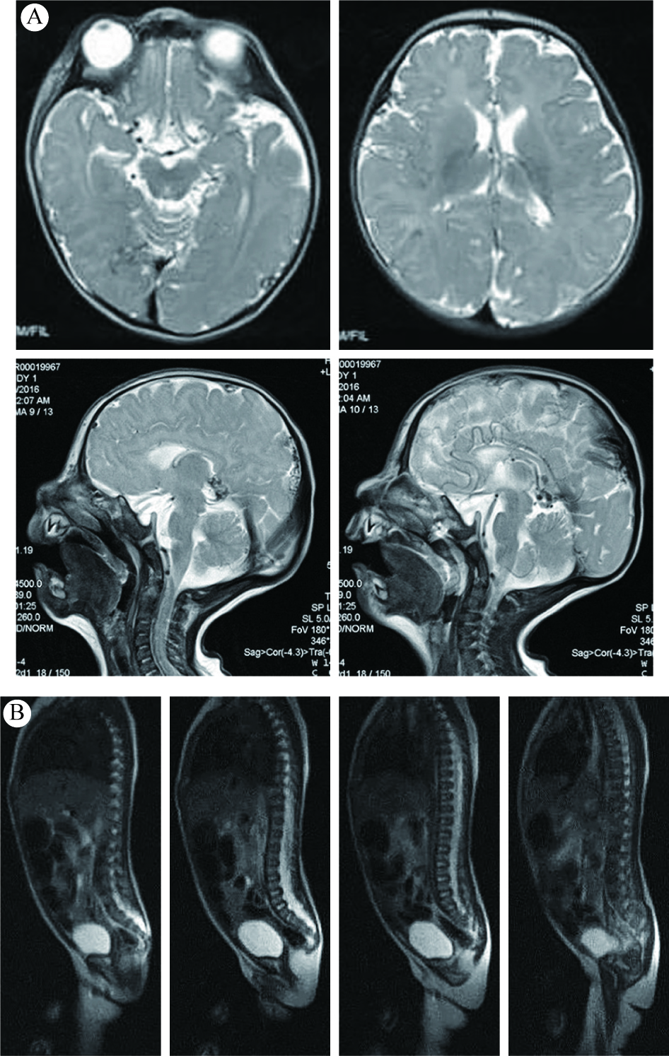 西藏藏族Cornelia de Lange综合征1例病例报告并文献复习